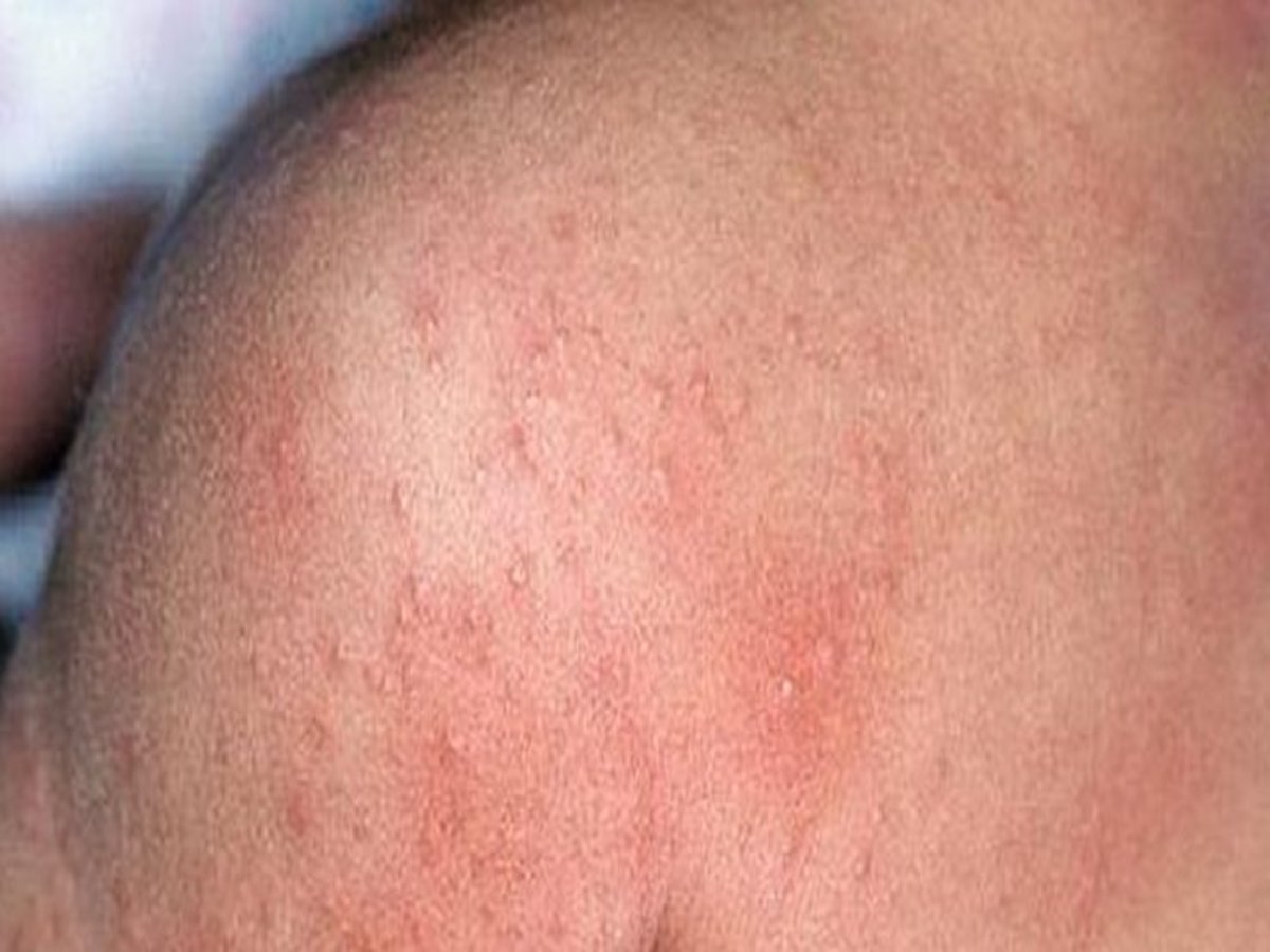 Home Remedies for Ghamoria - Times Bull